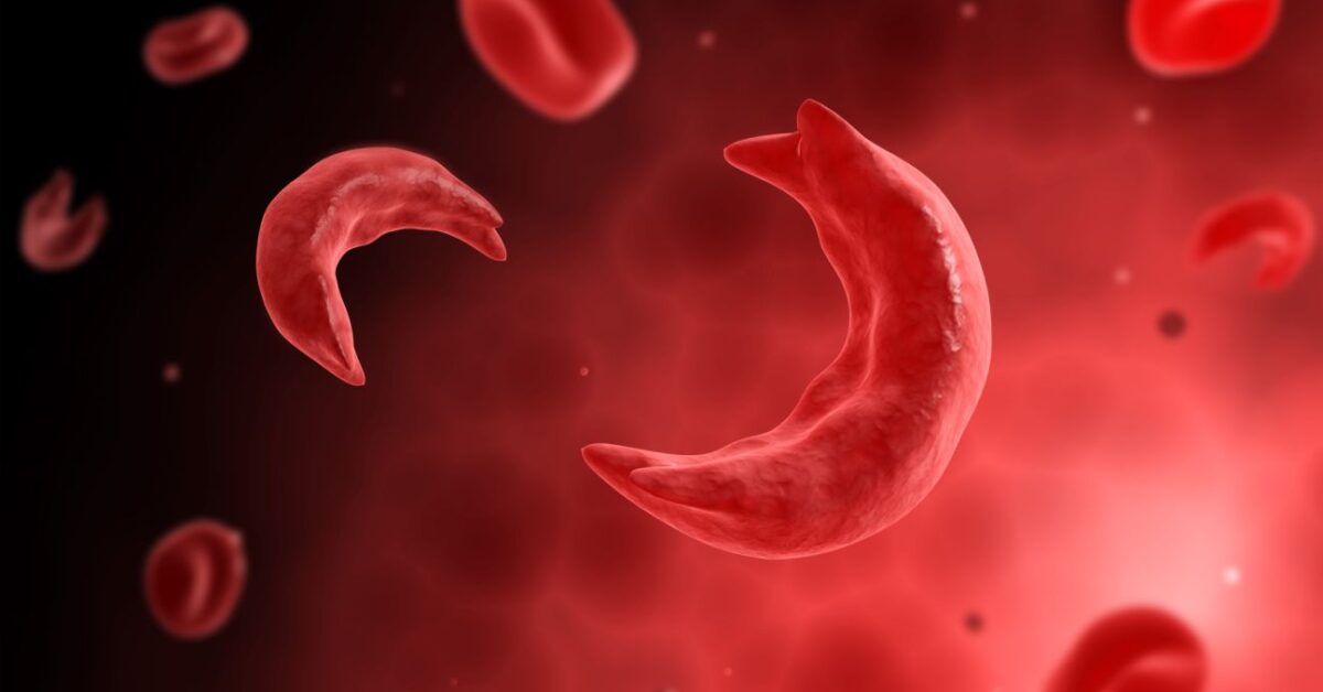 There's no cure for sickle cell disease, but spotting it early can improve treatment - Rafamall